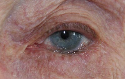 Entropium