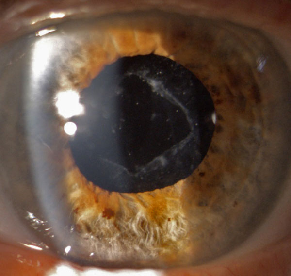 die Operation des Grauen Stars | Auge Online