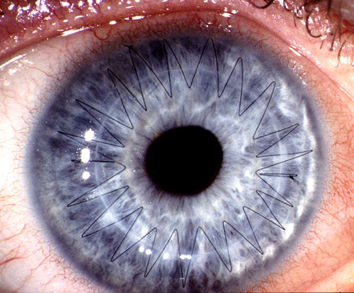 Hornhauterkrankungen | Auge Online