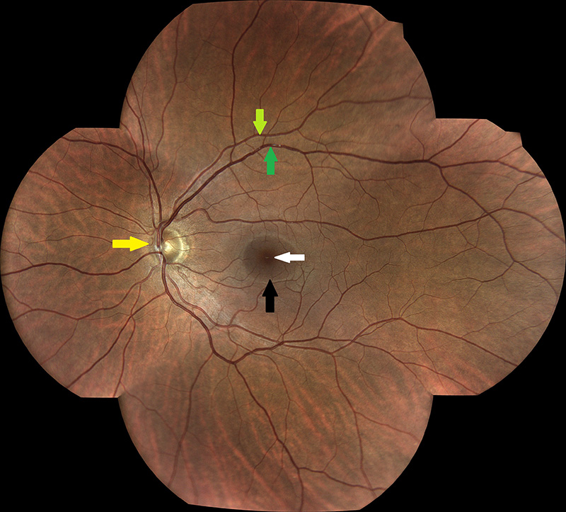 Netzhautbilder | Auge Online